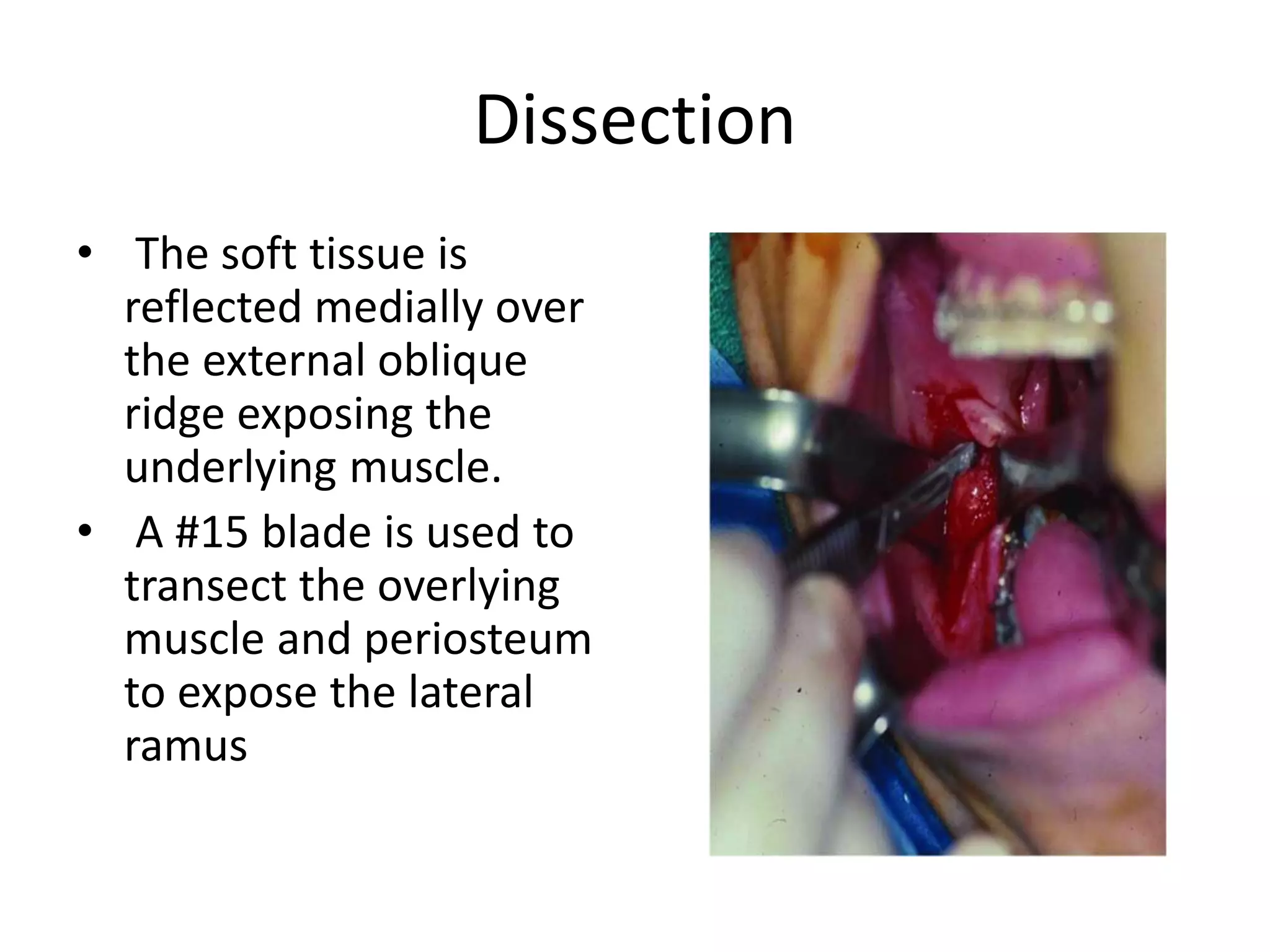 Bilteral sagittal split osteotomy | PPTX