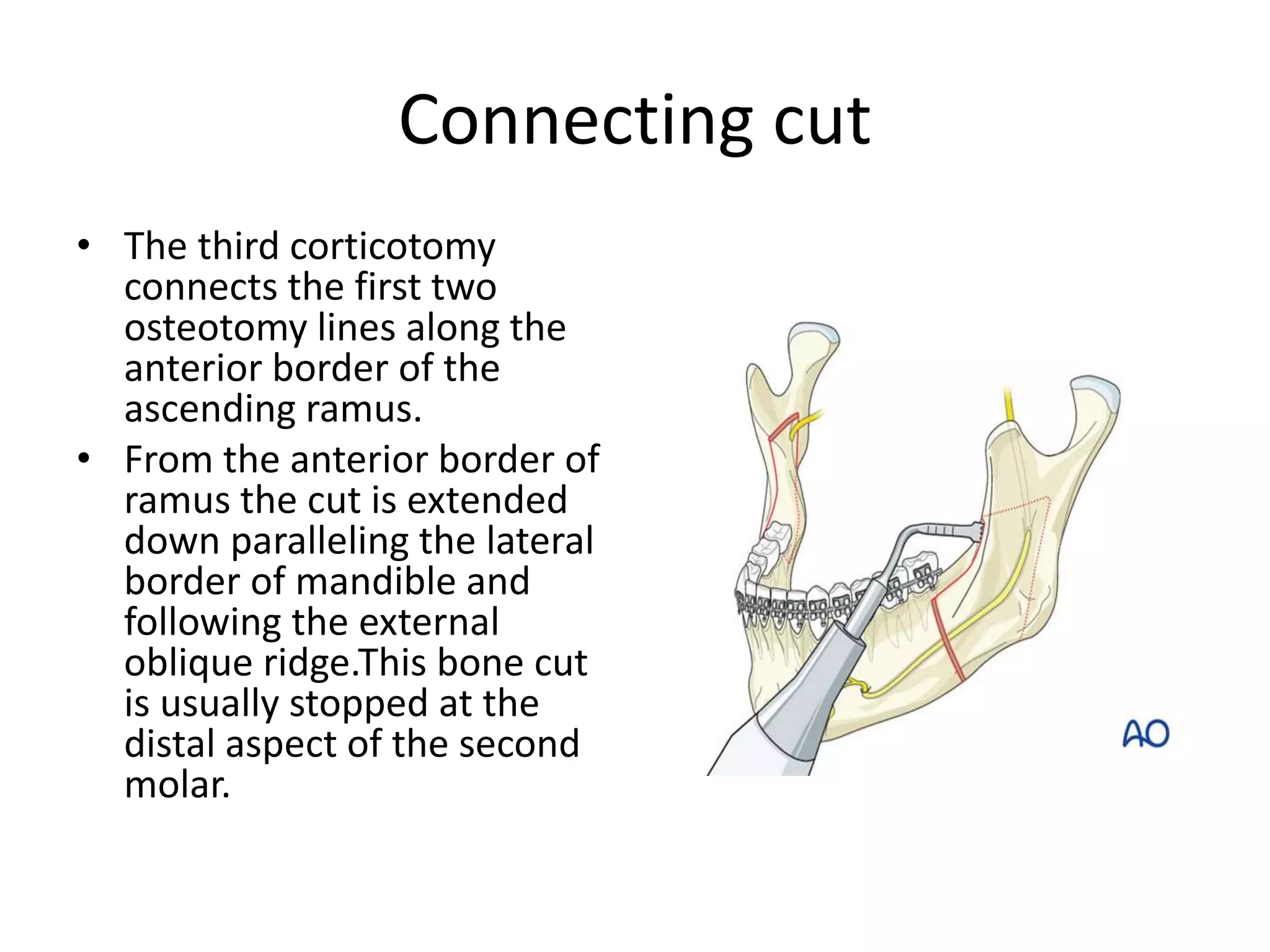 Bilteral sagittal split osteotomy | PPTX