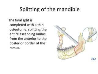 Bilteral sagittal split osteotomy | PPTX | Death, Injury, or Military ...