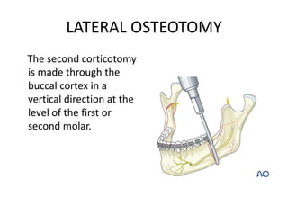 Bilteral sagittal split osteotomy | PPTX
