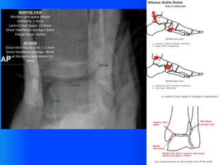 Bimalleolar fracture.pptx