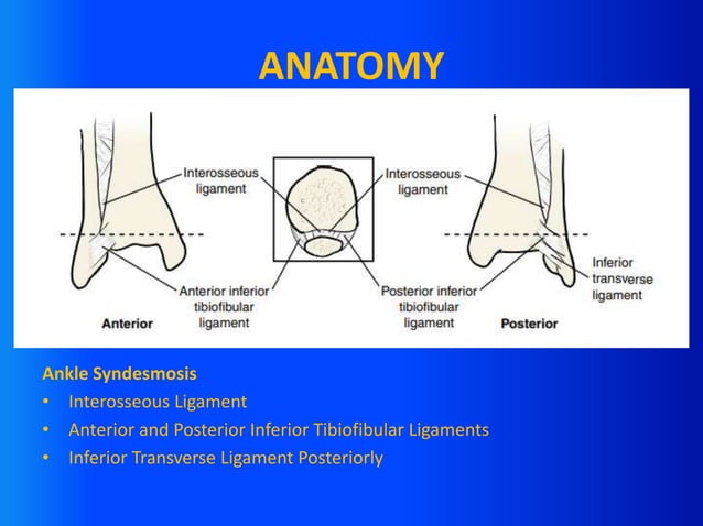Bimalleolar fracture.pptx
