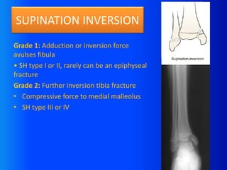 Bimalleolar fracture.pptx