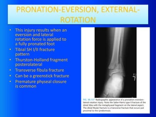 Bimalleolar fracture.pptx