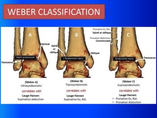 Bimalleolar fracture.pptx