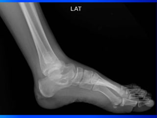 Bimalleolar fracture.pptx