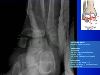 Bimalleolar fracture.pptx