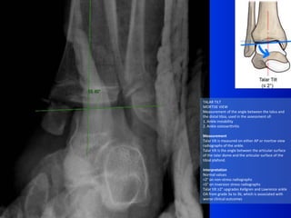 Bimalleolar fracture.pptx