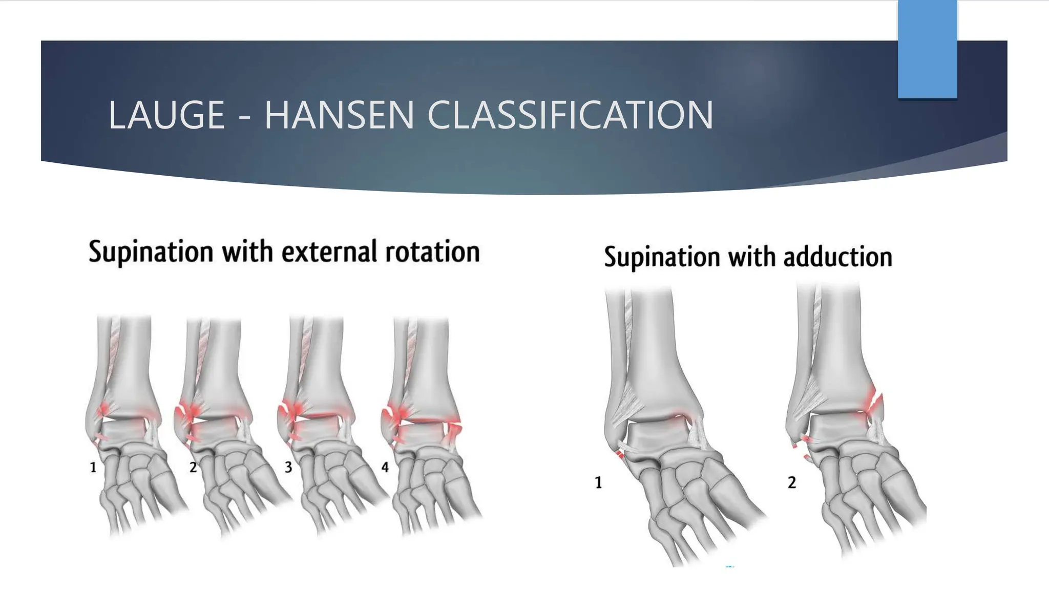 BIMALLEOLAR FRACTURES mechanism and anapath.pptx
