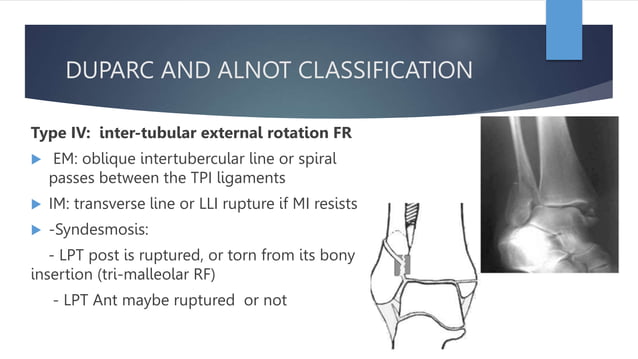 BIMALLEOLAR FRACTURES mechanism and anapath.pptx | Death, Injury, or ...