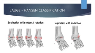 BIMALLEOLAR FRACTURES mechanism and anapath.pptx