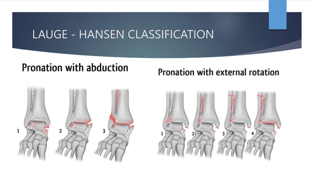 BIMALLEOLAR FRACTURES mechanism and anapath.pptx | Death, Injury, or ...