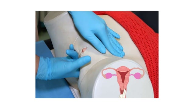 Bimanual Examination Pptx