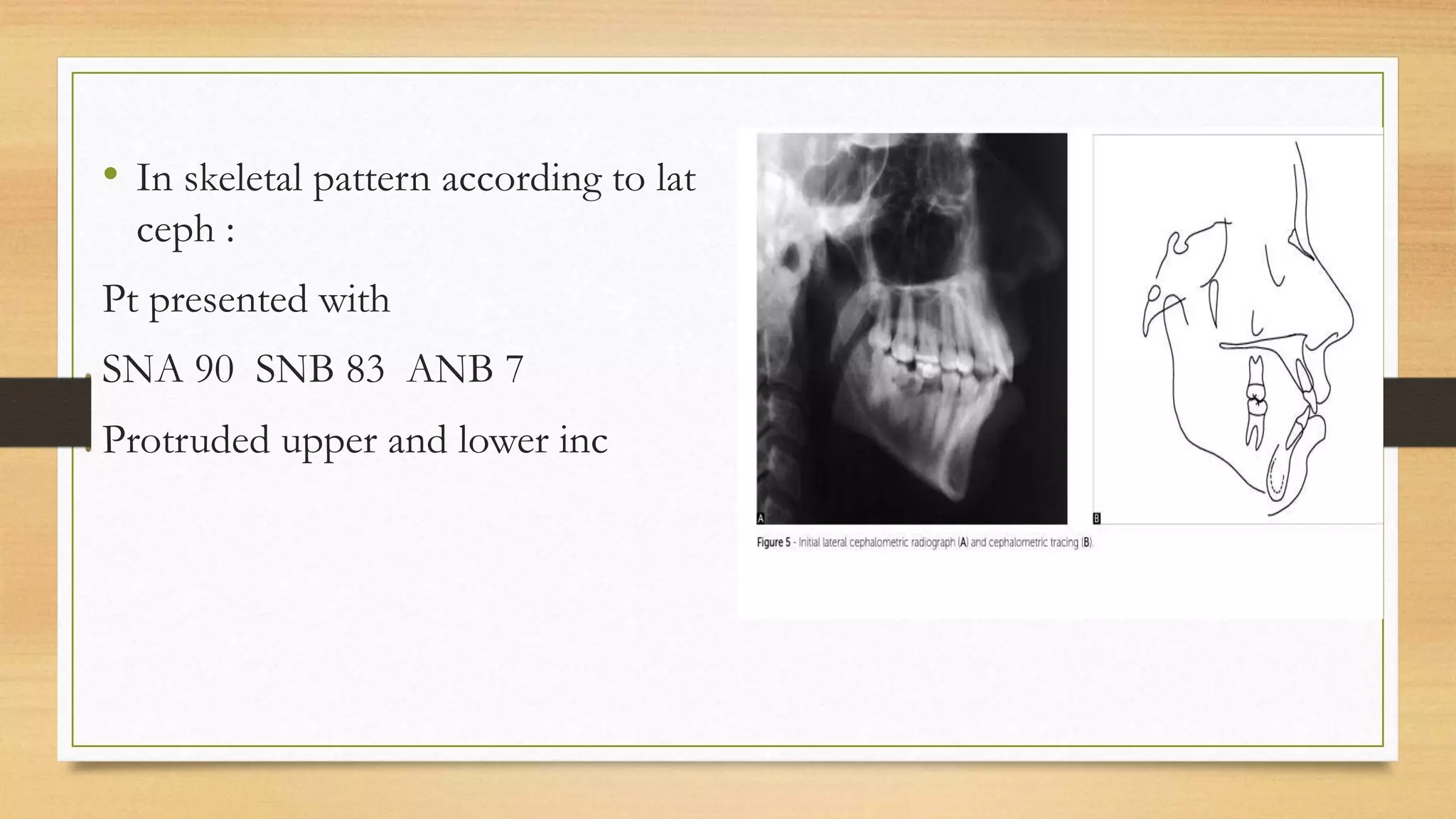 Bimaxillary proclination | PPTX