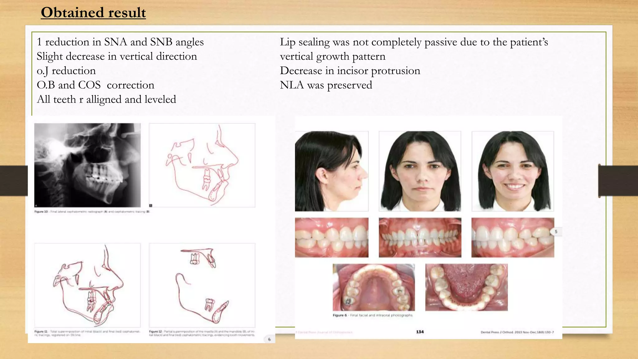 Bimaxillary proclination | PPTX