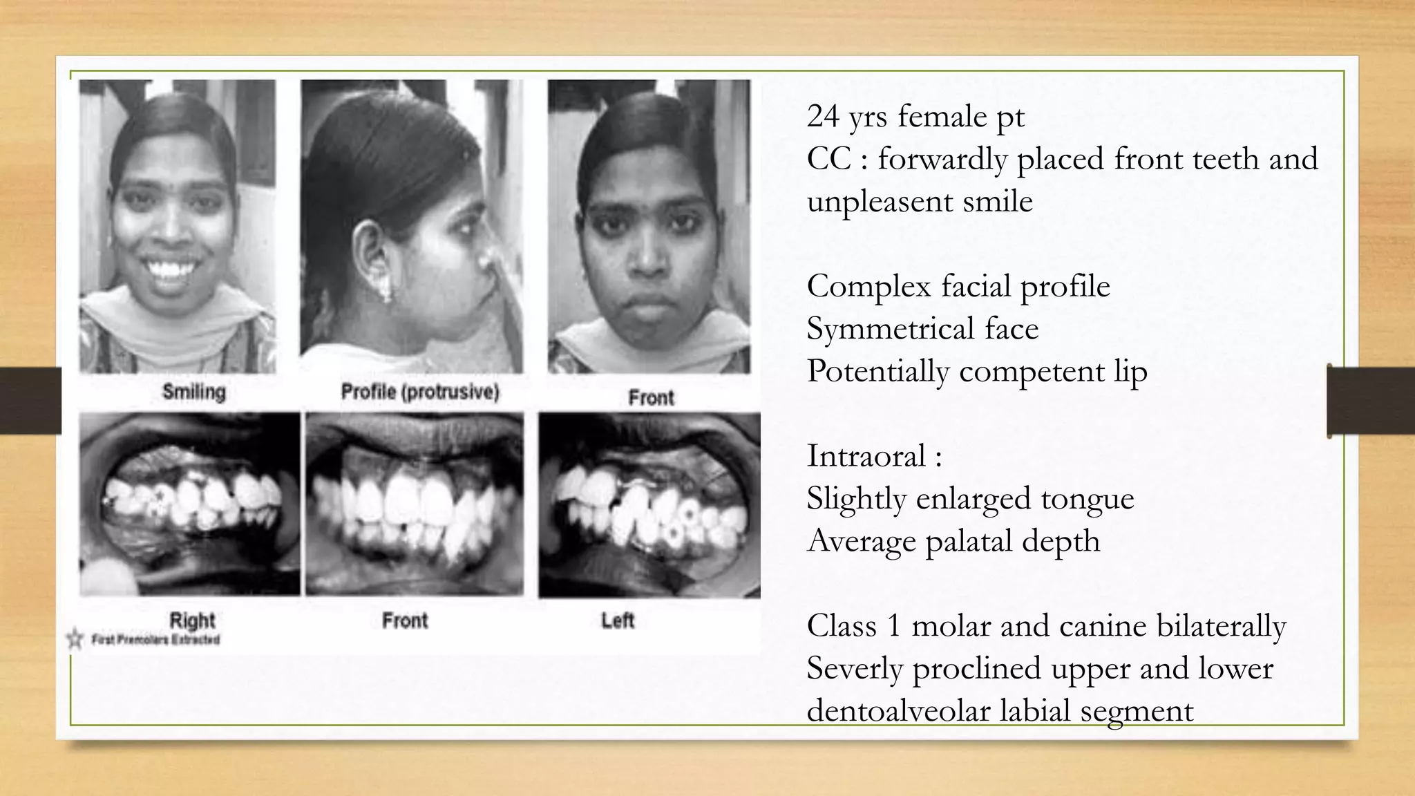 Bimaxillary proclination | PPTX