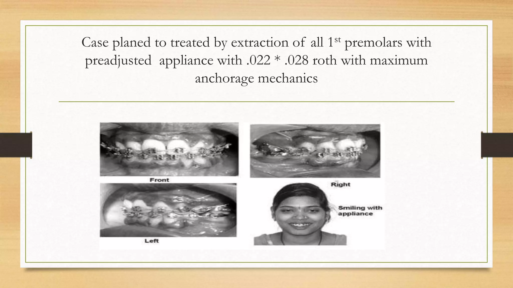 Bimaxillary proclination | PPTX