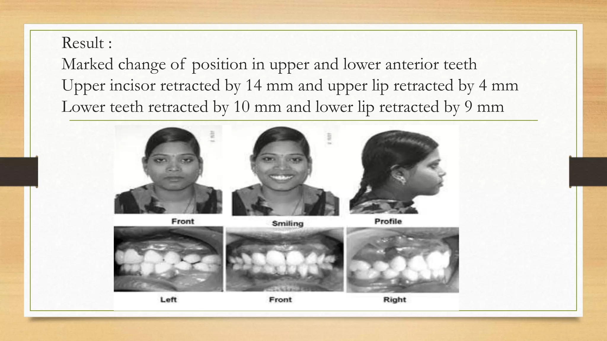 Bimaxillary proclination | PPTX