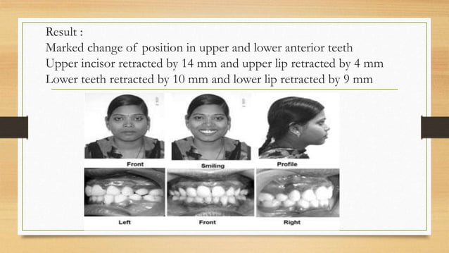 Bimaxillary proclination | PPTX | Dental Health | Diseases and Conditions