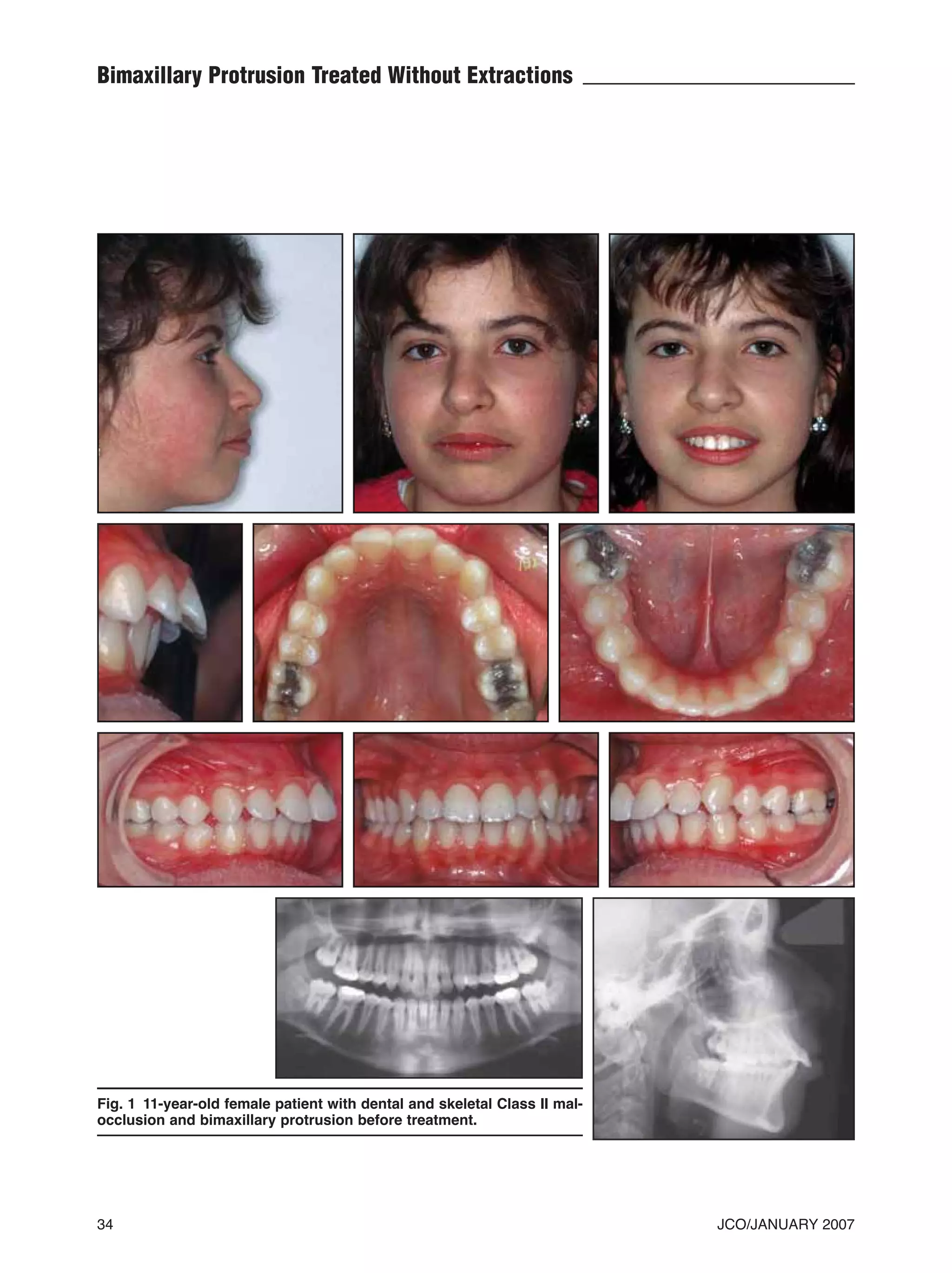 Bimaxillary protrusion treated without extraction | PDF