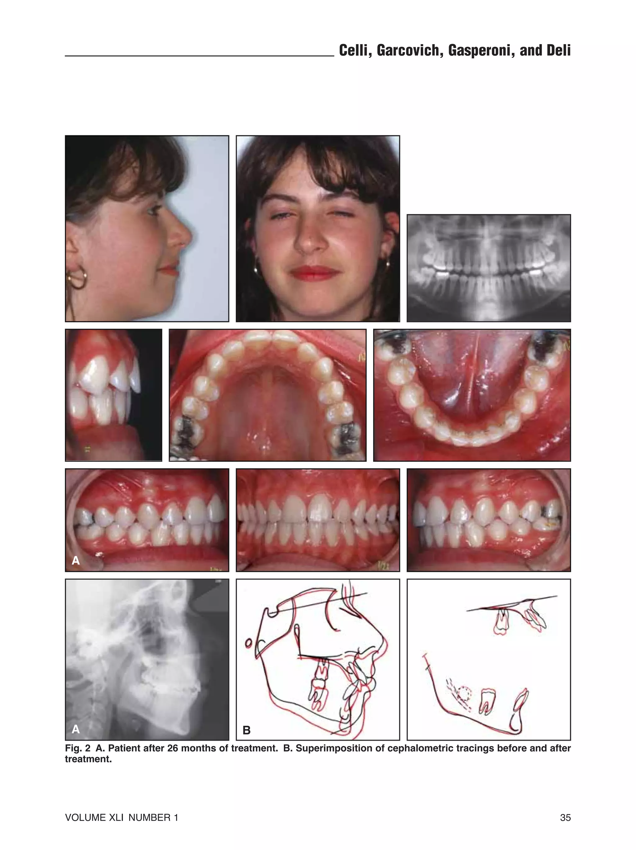 Bimaxillary protrusion treated without extraction | PDF