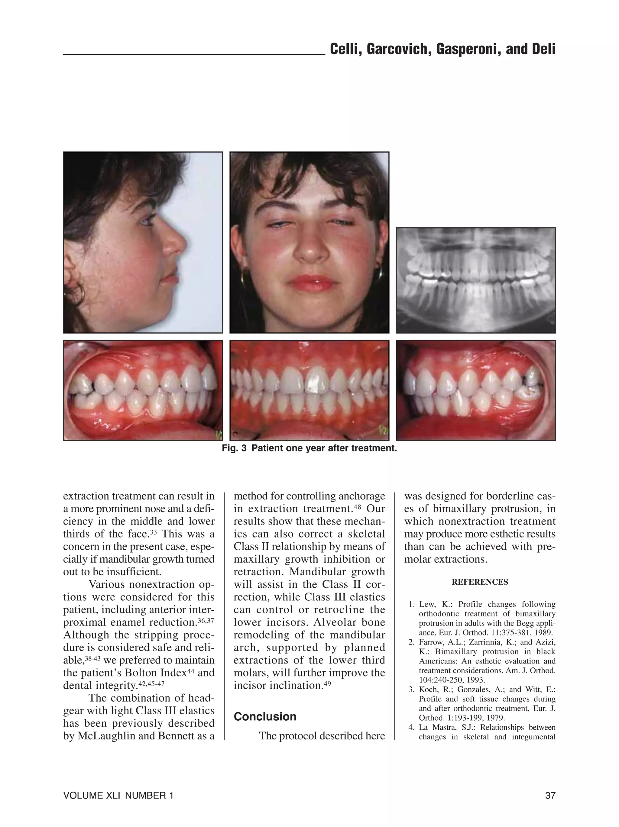Bimaxillary protrusion treated without extraction | PDF