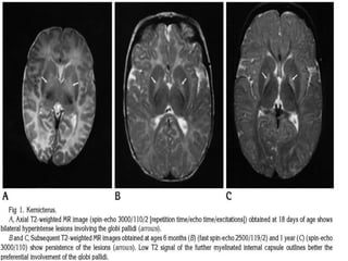 Kernicterus/BIND-pathogenesis | PPTX