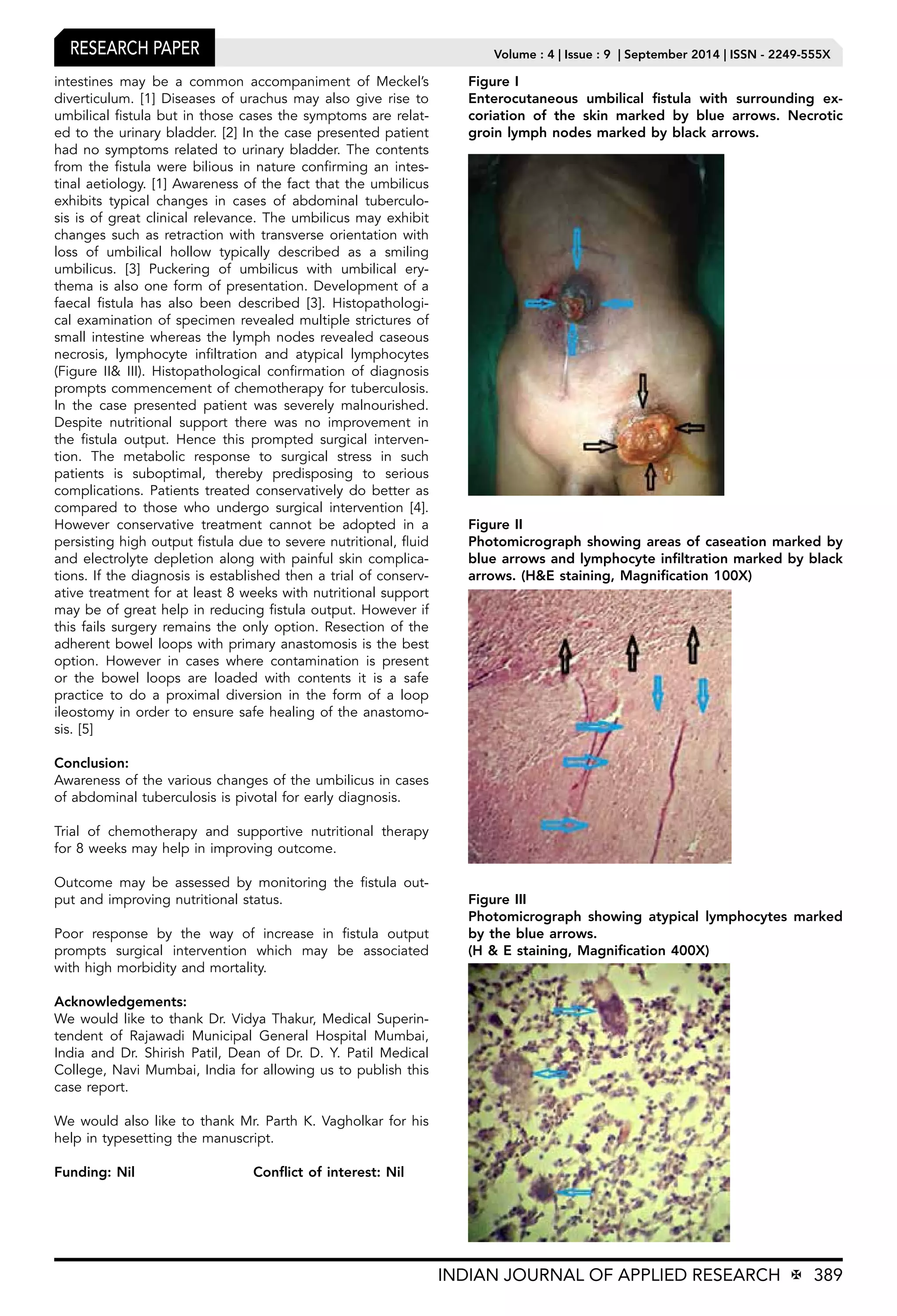 Enterocutaneous Umbilical Fistula: An Uncommon Manifestation of ...