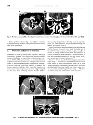 Tension pneumo orbitus e A case report and review of literature | PDF