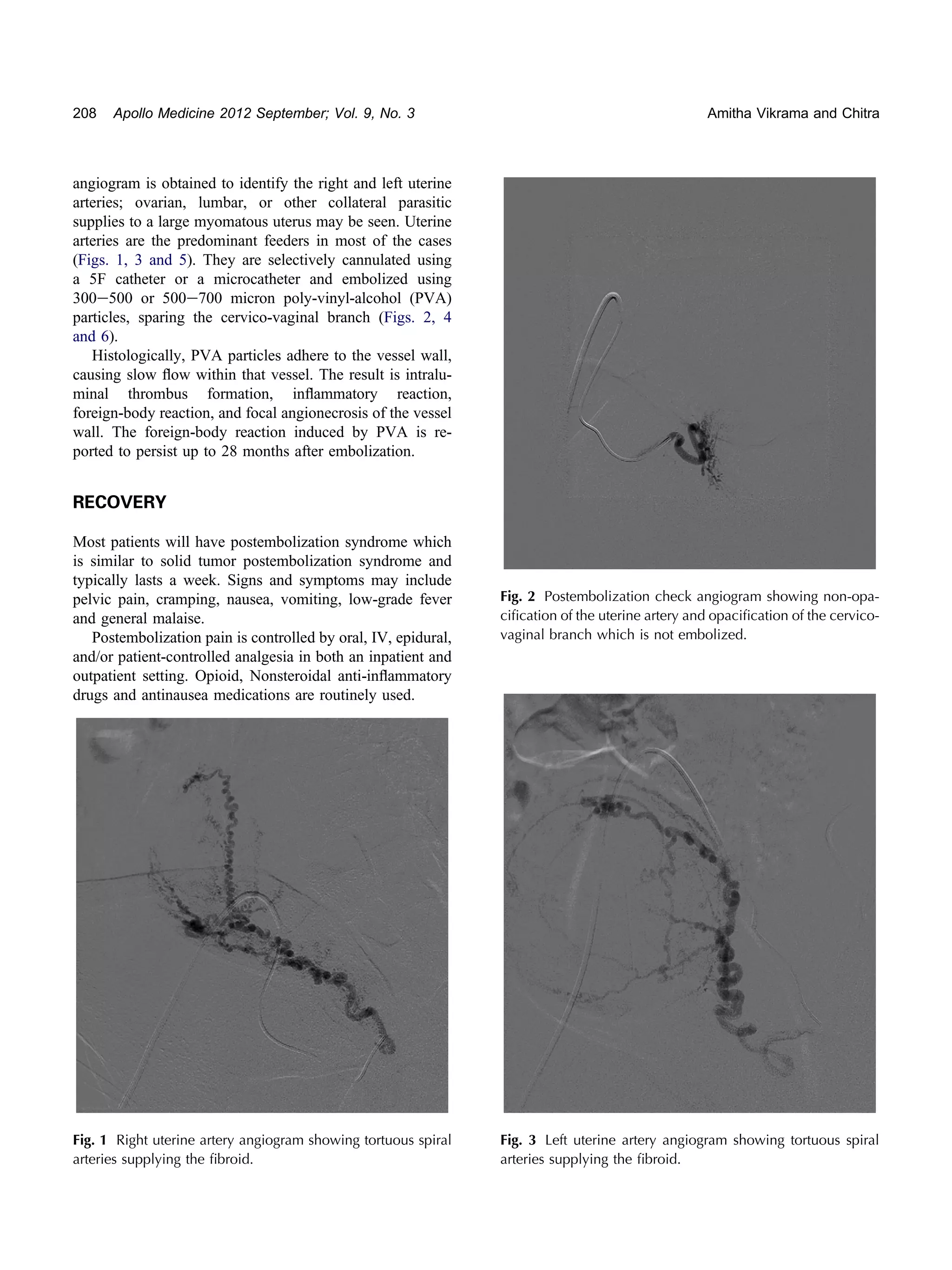 The role of uterine artery embolization in gynecology practice | PDF