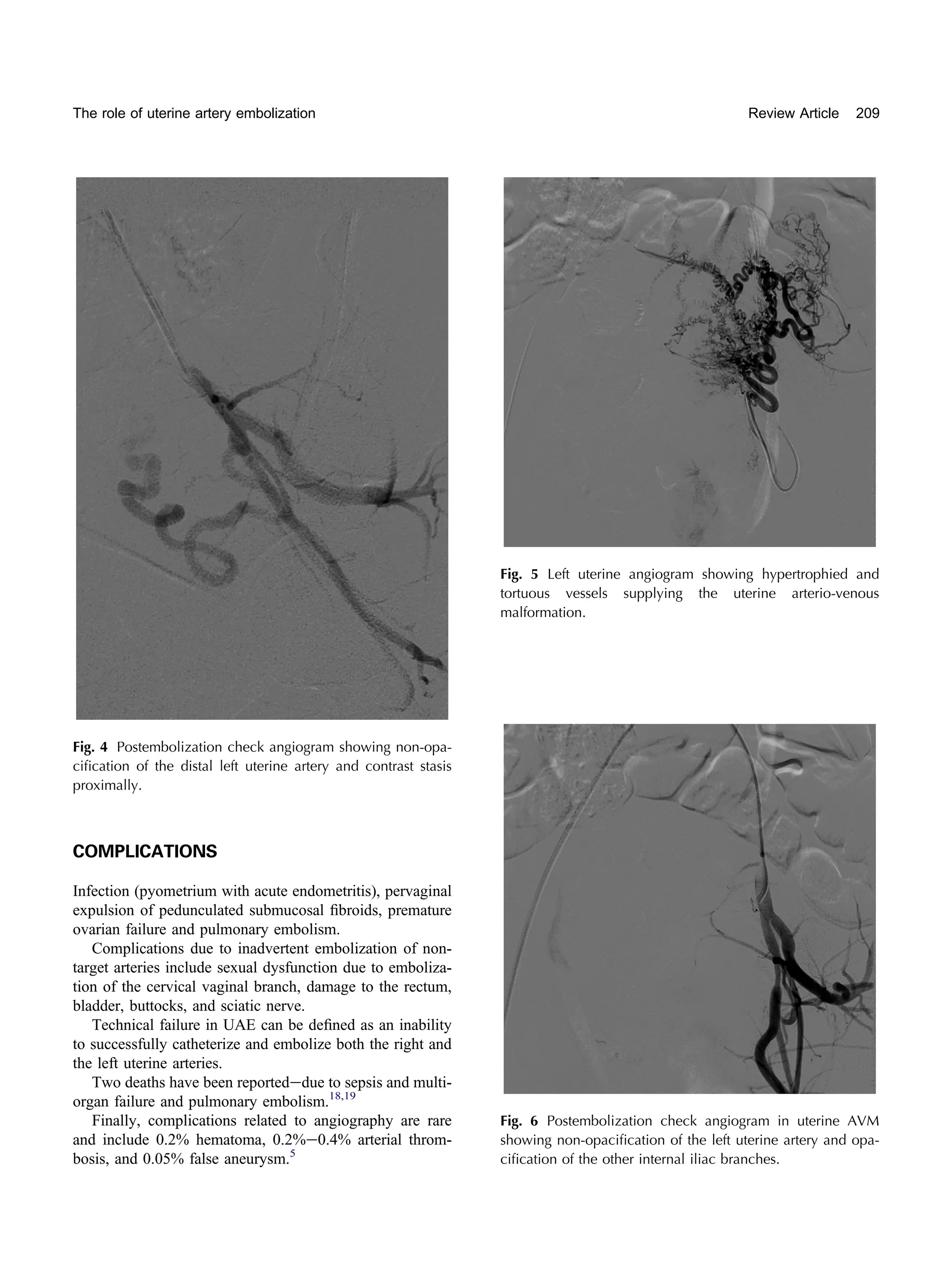 The role of uterine artery embolization in gynecology practice | PDF