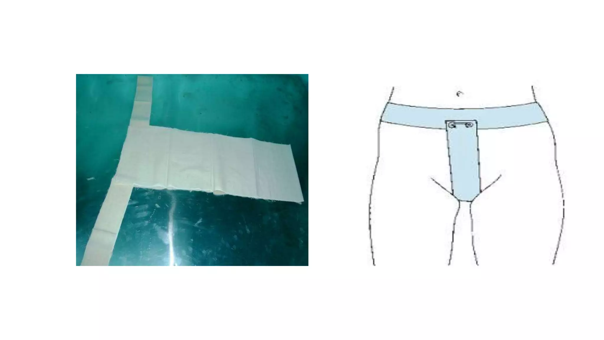 Binder and splint ppt | PPTX