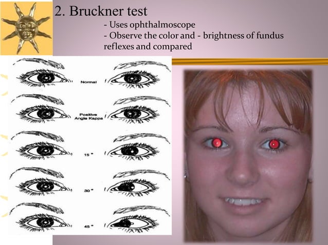 Binocular anomalies What we should know? | PPTX | Eye and Vision ...