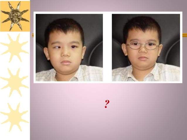 Binocular anomalies What we should know? | PPTX | Eye and Vision ...