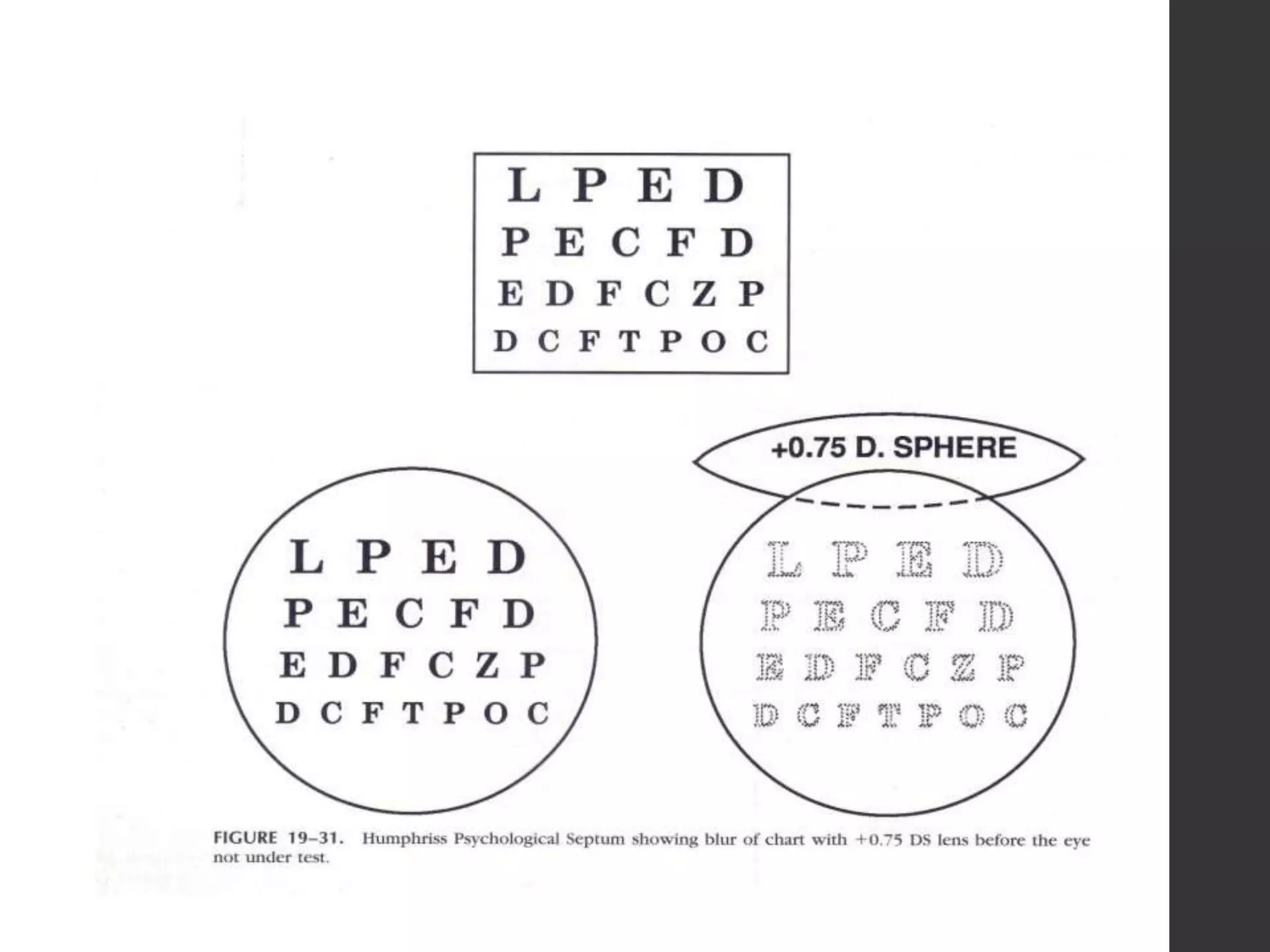 Binocular refraction techniques, binocular balancing & binocular | PPTX