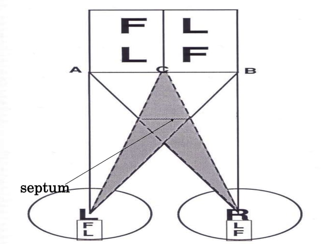 Binocular refraction techniques, binocular balancing & binocular | PPTX