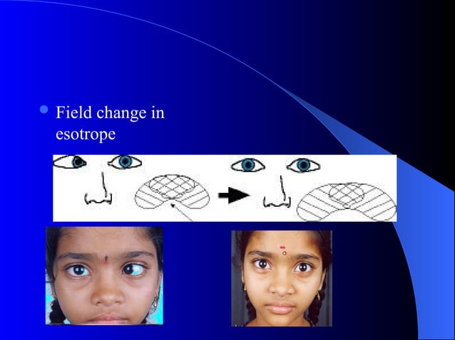 Basics of BINOCULAR SINGLE VISION.ppt
