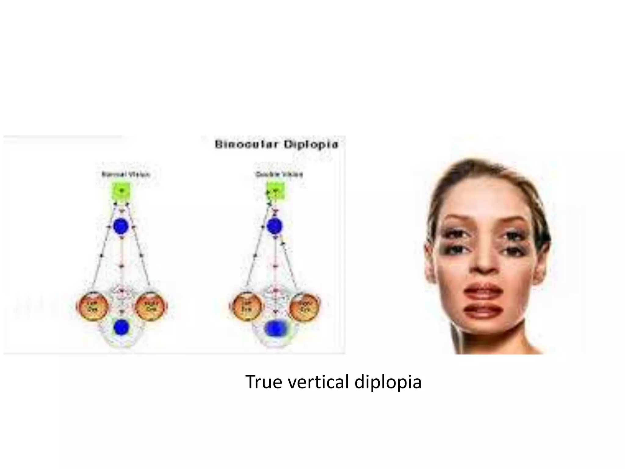 Binocular vision and stereopsis | PPTX