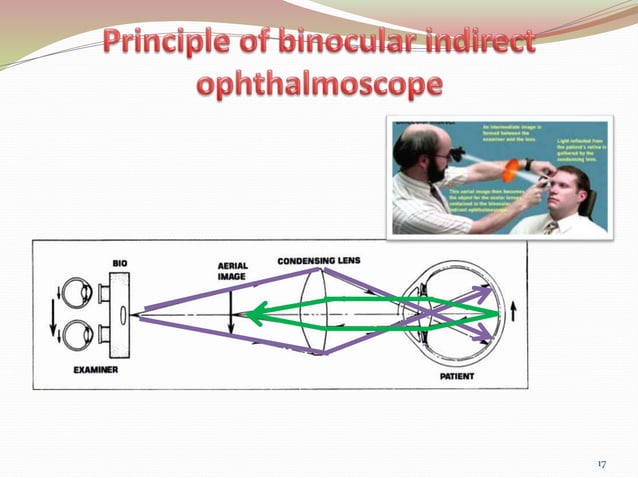 Binocular Indirect Ophthalmoscopy | PPTX