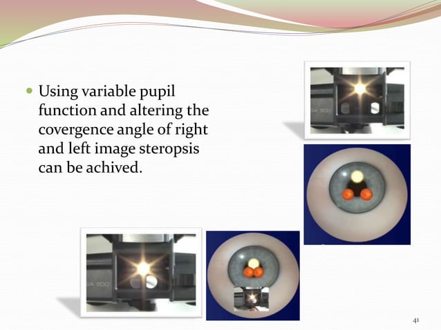 Binocular Indirect Ophthalmoscopy | PPTX