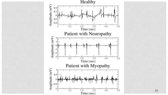 Bio medical signal analysis(both normal and abnormal)
