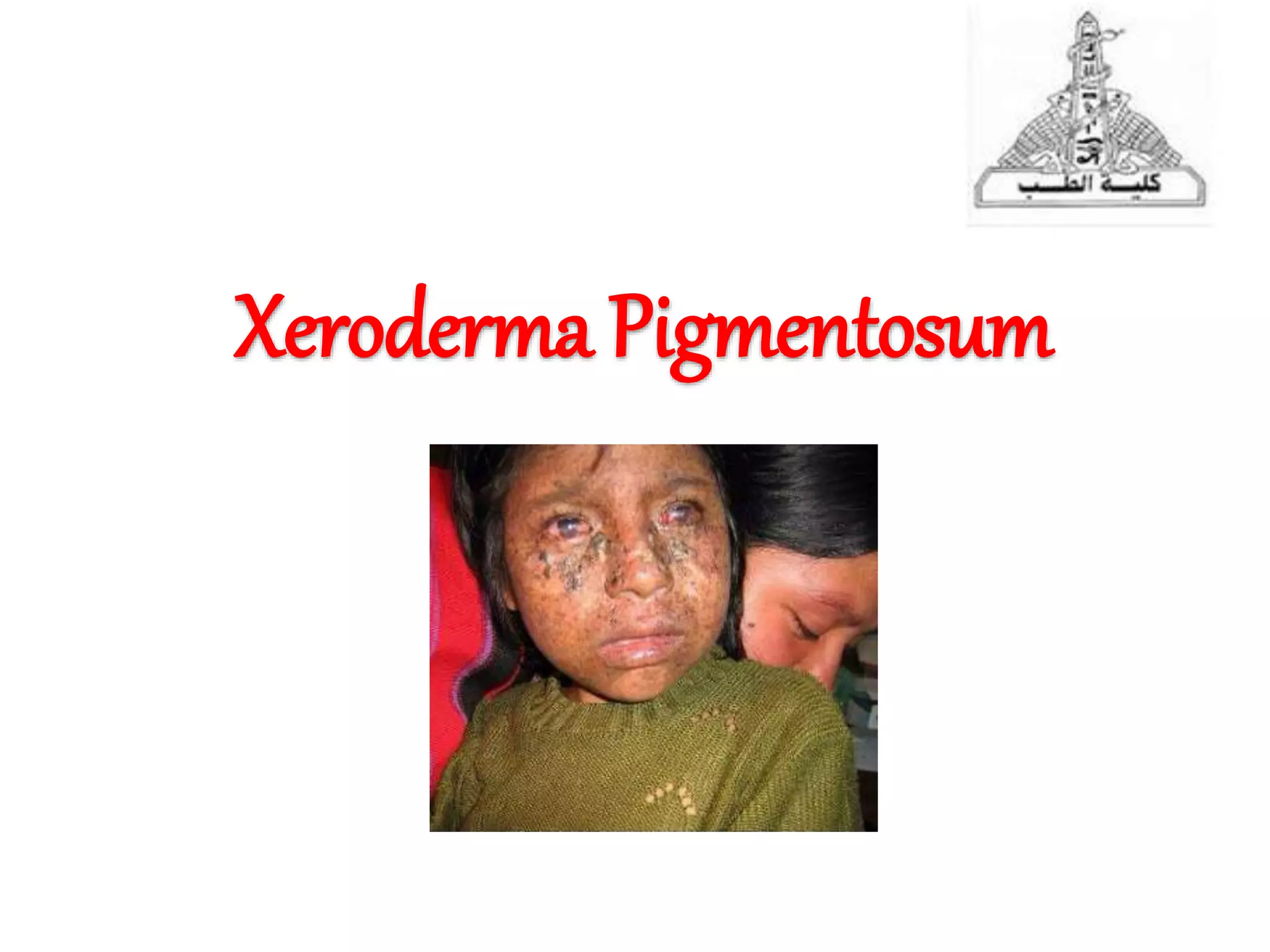 Xeroderma pigmentosum | PPTX