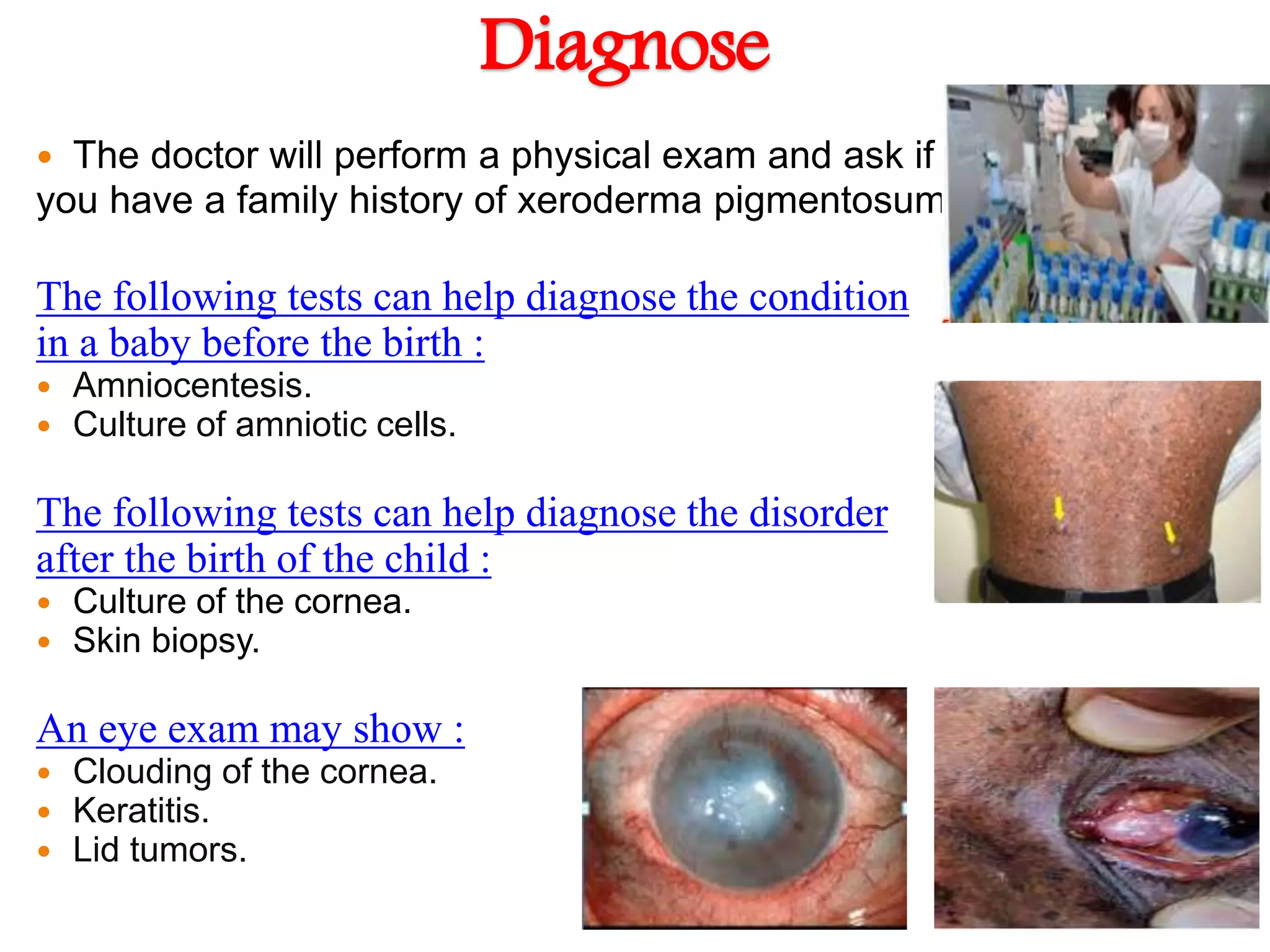 Xeroderma pigmentosum | PPTX