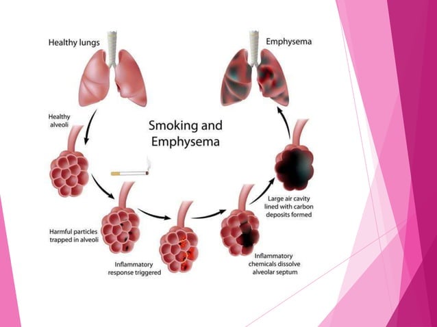 BIO168 Emphysema Presentation | PPTX | Lung and Respiratory Health ...
