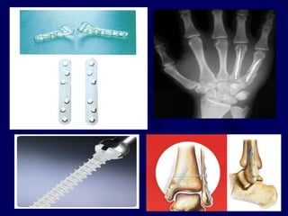 Bioabsorbable Implants in Orthopaedics - Dr Chintan N Patel | PPT