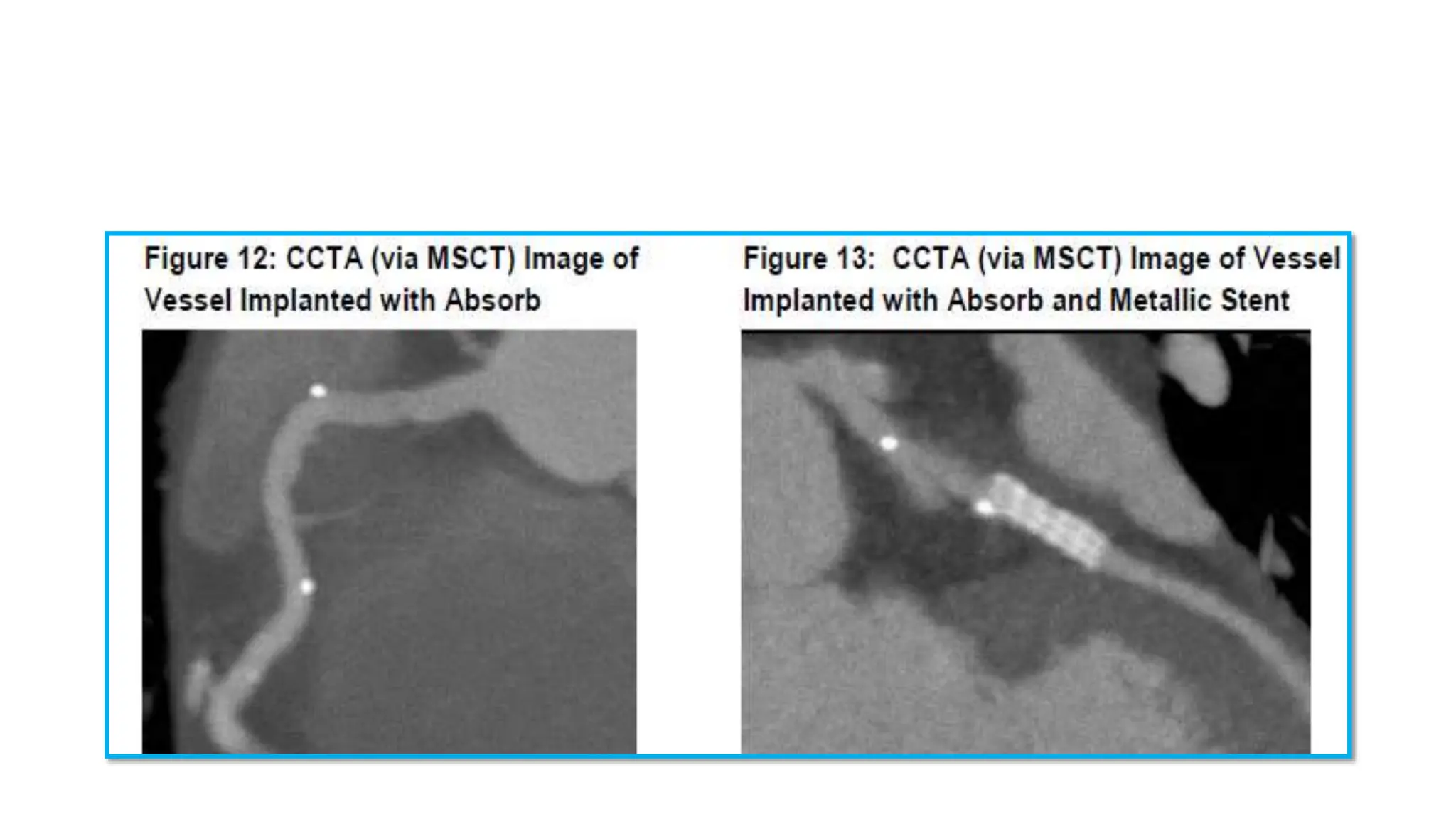 BIOABSORBABLE VASCULAR SCAFFOLD AND ITS APPLICATIONOLD.pptx