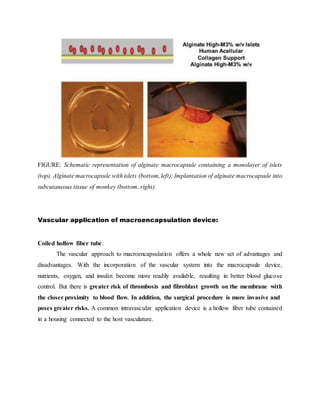 Bioartificial pancreas | DOCX