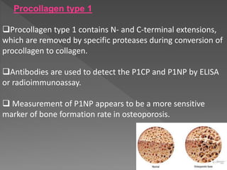 Biochemical markers of bone remodeling | PPTX