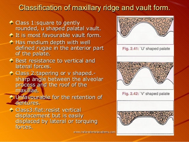 Classification of edentulous ridge - jessmile