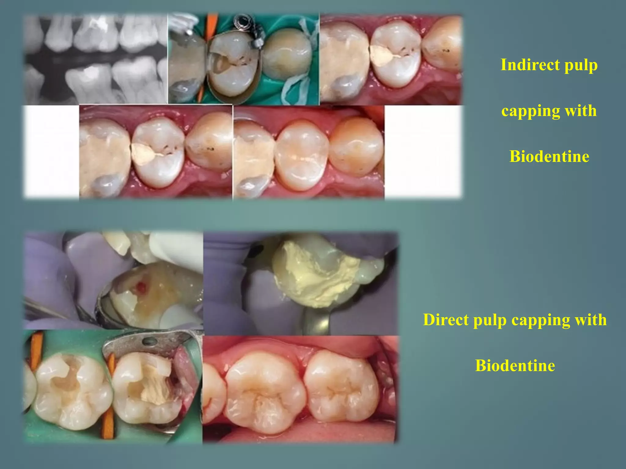 Biodentine™ | PDF